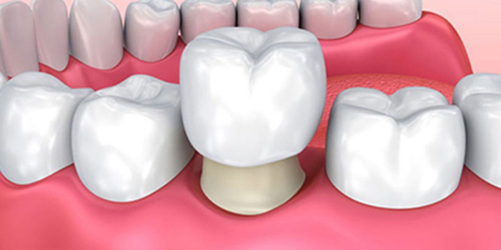 Quelques raisons d'opter pour une couronne dentaire.